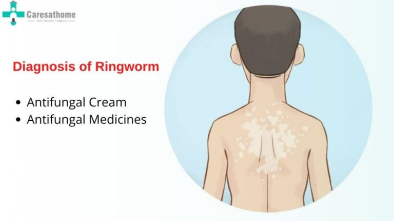 Diagnosis of Ringworm - Cares at Home - Blog